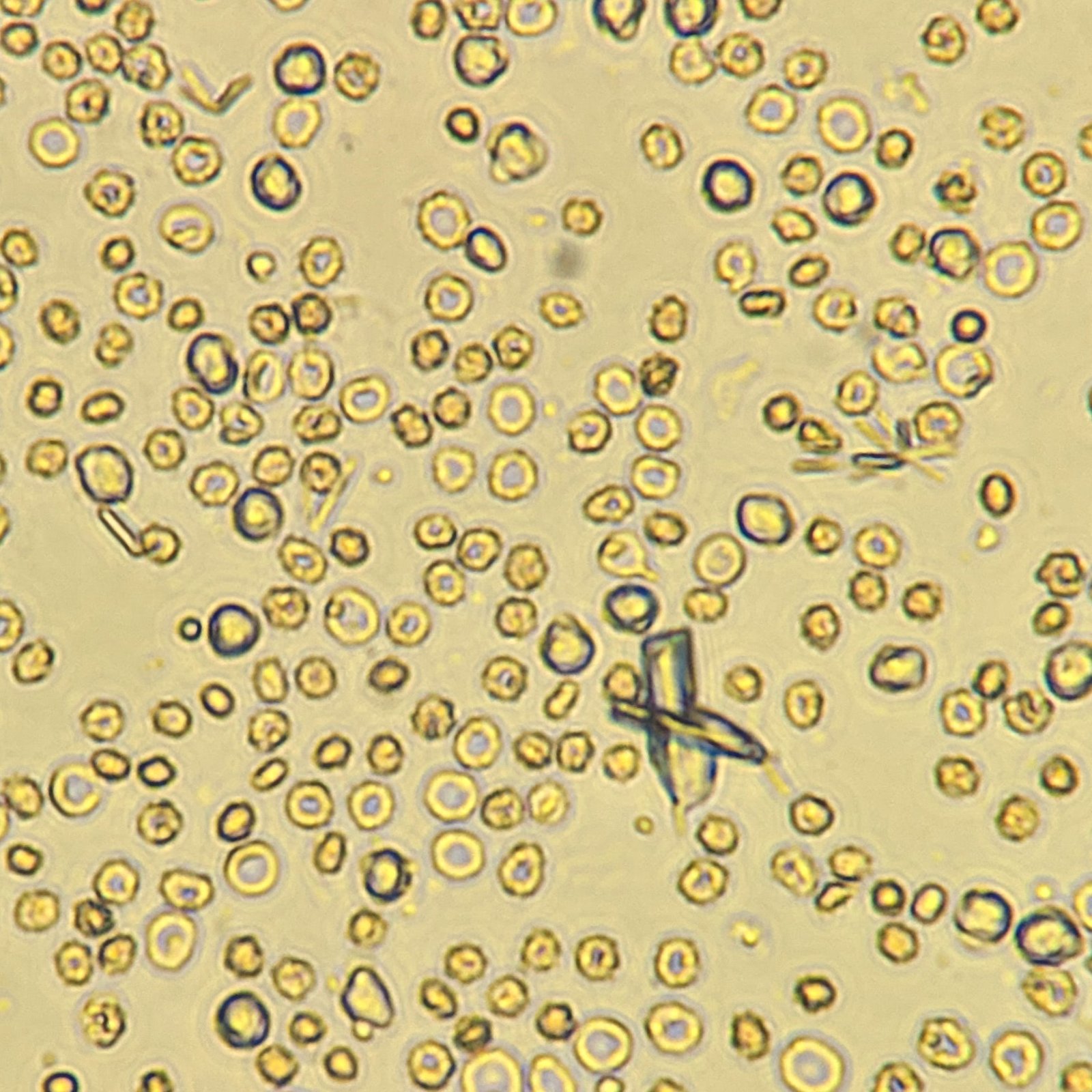 Calcium Phosphate Crystals: Identification & Clinical Significance