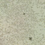 Calcium Phosphate Crystals: Identification & Clinical Significance