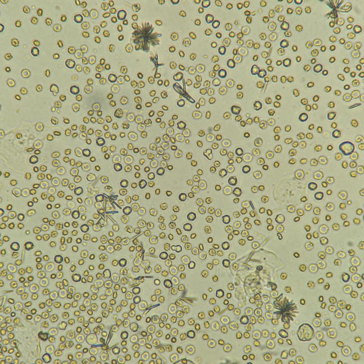 Calcium Phosphate Crystals: Identification & Clinical Significance