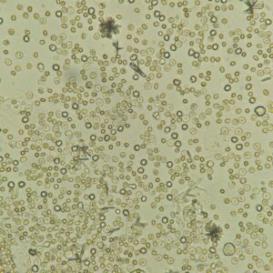 Calcium Phosphate Crystals: Identification & Clinical Significance