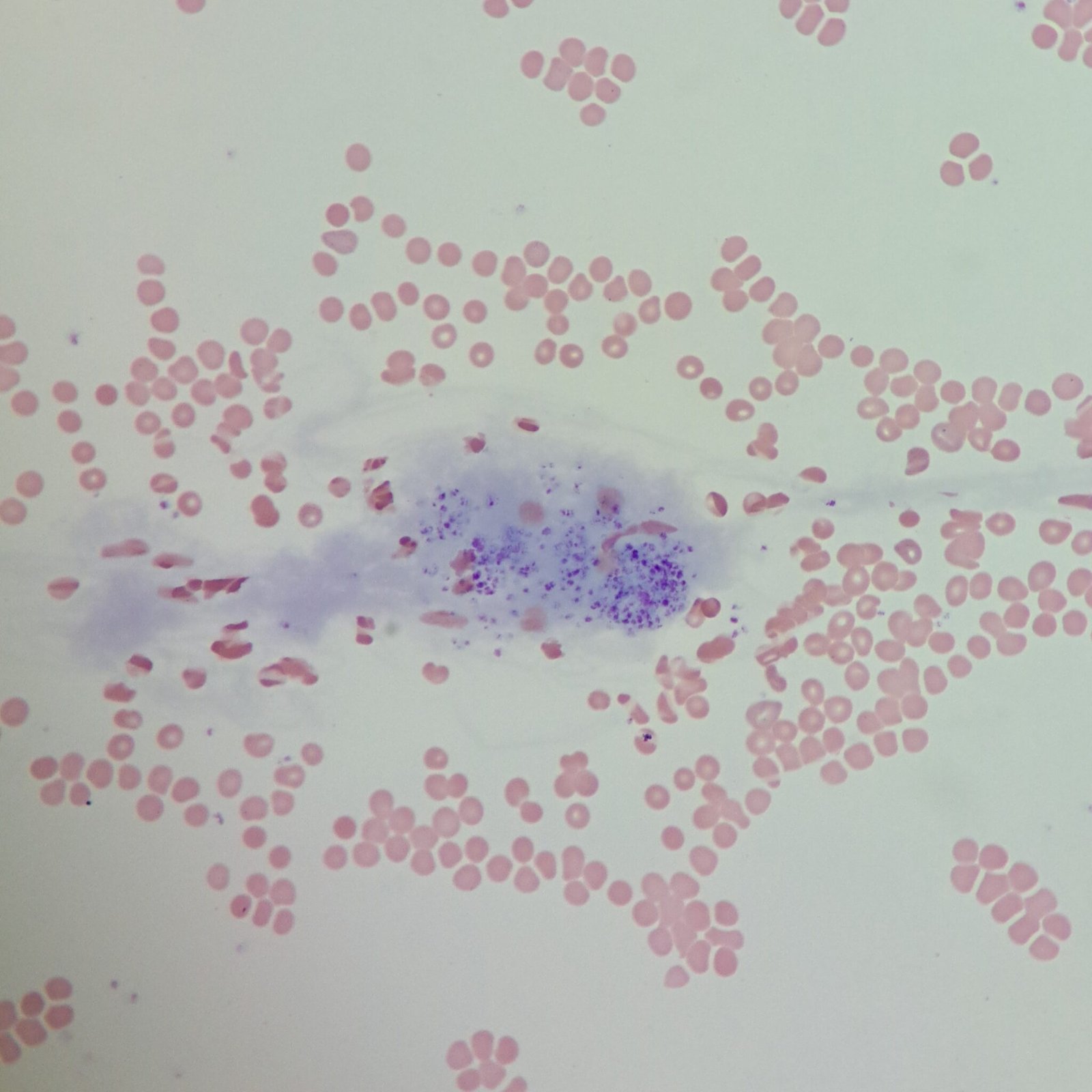 Platelets: Giant & Large, Clots & Clumps
