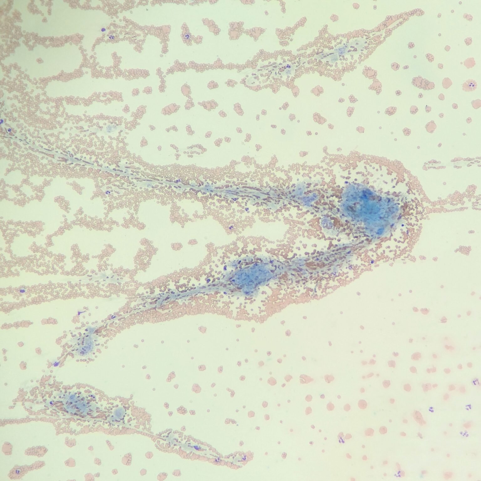 Platelets: Giant & Large, Clots & Clumps