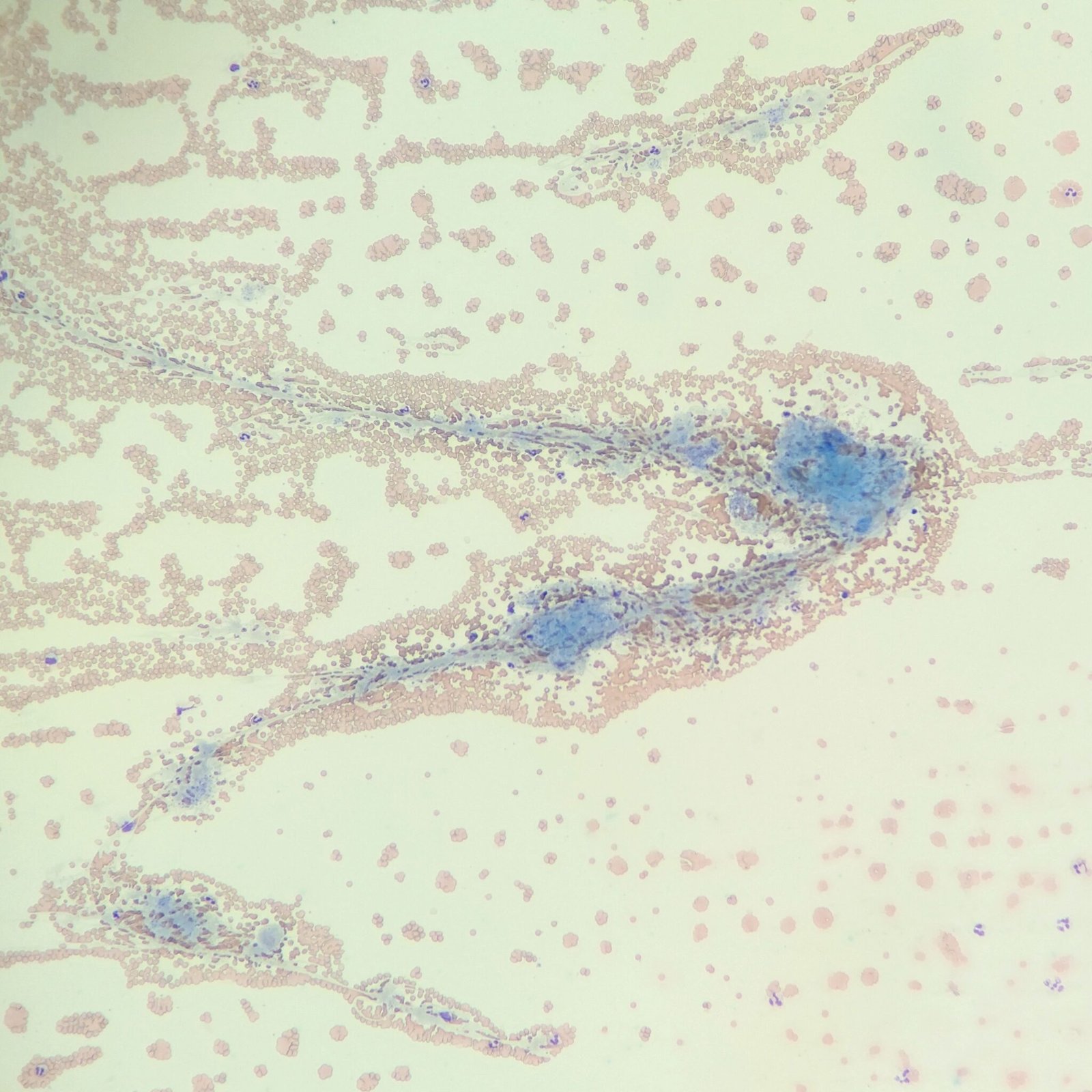 Platelets: Giant & Large, Clots & Clumps