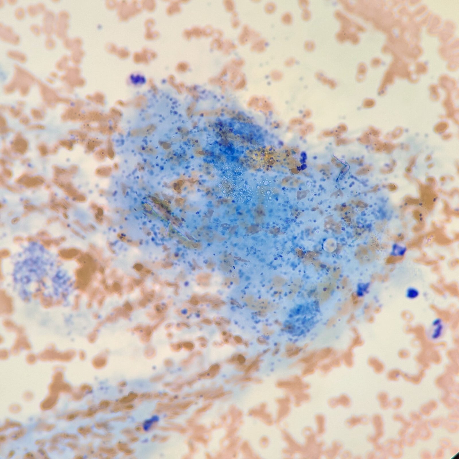Platelets: Giant & Large, Clots & Clumps