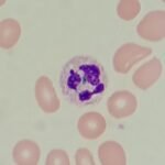 Critical Green Inclusions: Appearance & Clinical Significance - MedLabBuddy