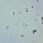 Cystine Crystals: Identification & Clinical Significance