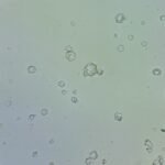 Cystine Crystals: Identification & Clinical Significance