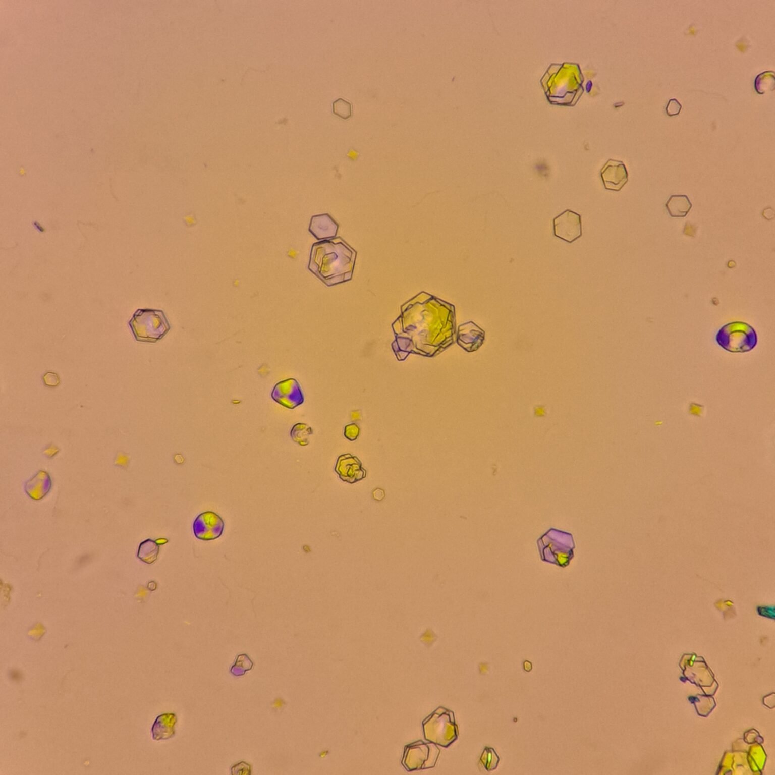 Cystine Crystals: Identification & Clinical Significance