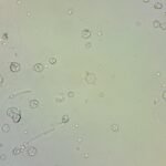 Cystine Crystals: Identification & Clinical Significance