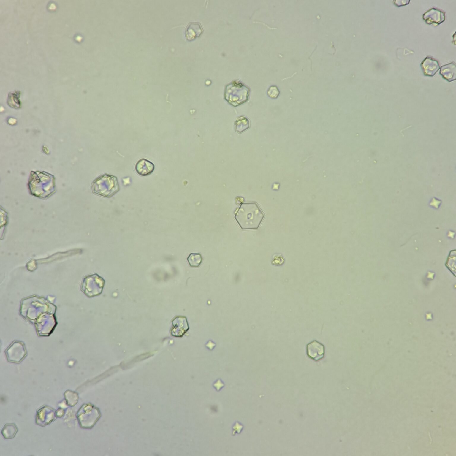 Cystine Crystals: Identification & Clinical Significance