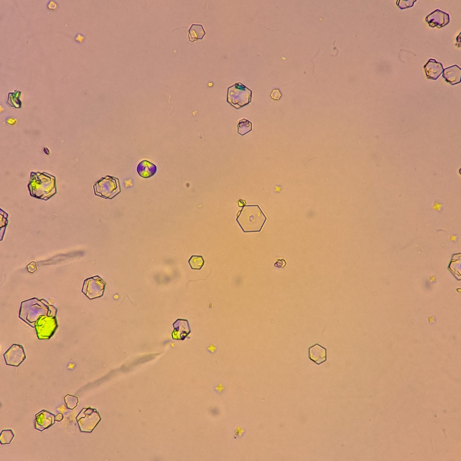 Cystine Crystals: Identification & Clinical Significance