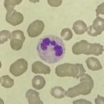 Dohle Bodies in Neutrophils: Appearance & Clinical Significance ...