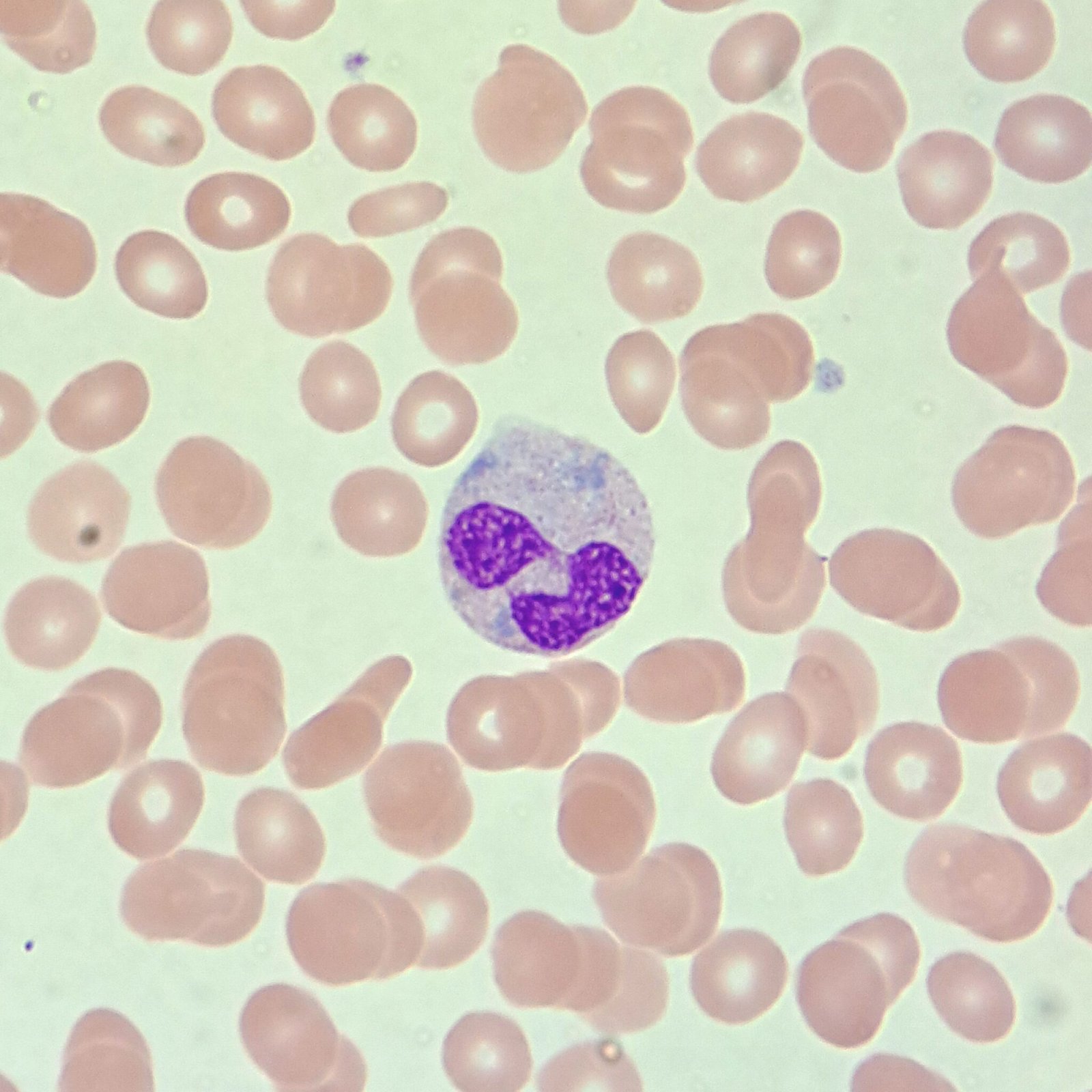 Dohle Bodies in Neutrophils: Appearance & Clinical Significance ...