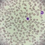Elliptocytes / Ovalocytes: Appearance & Clinical Significance - MedLabBuddy