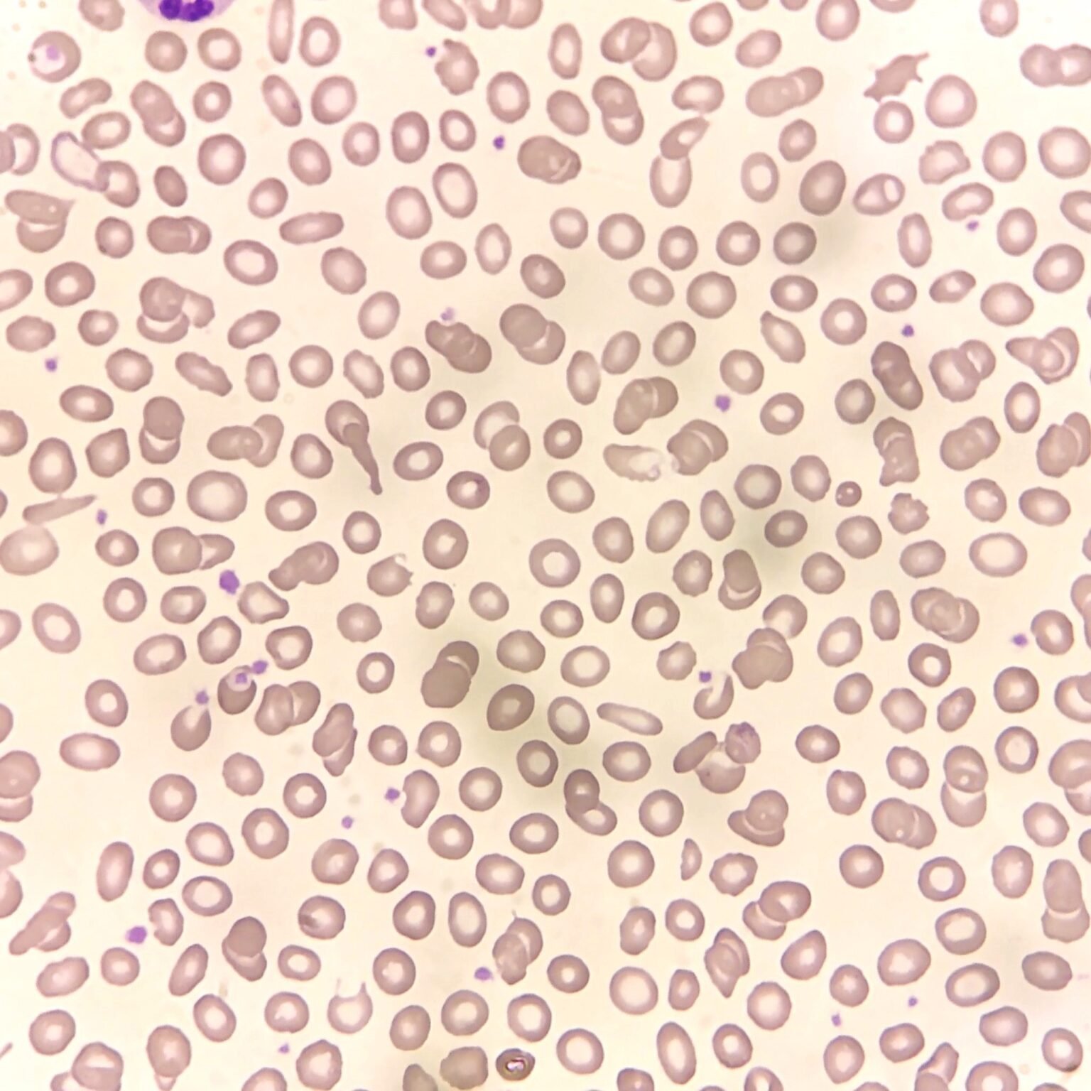 Elliptocytes / Ovalocytes on Blood Smear: Morphology & Causes