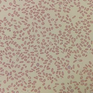 Elliptocytes / Ovalocytes on Blood Smear: Morphology & Causes