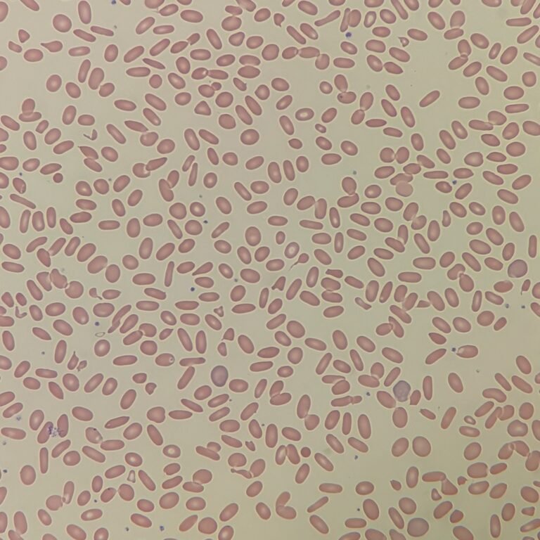 Elliptocytes / Ovalocytes on Blood Smear: Morphology & Causes