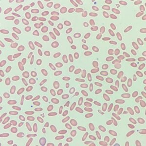 Elliptocytes / Ovalocytes: Appearance & Clinical Significance - MedLabBuddy