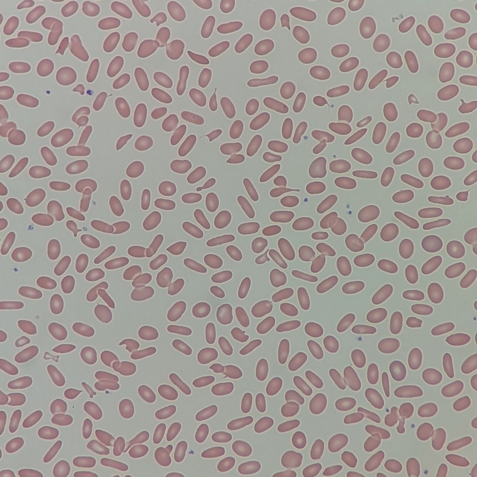 Elliptocytes / Ovalocytes: Appearance & Clinical Significance - MedLabBuddy