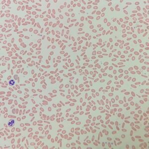 Elliptocytes / Ovalocytes on Blood Smear: Morphology & Causes