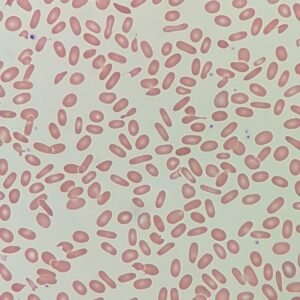 Elliptocytes / Ovalocytes on Blood Smear: Morphology & Causes