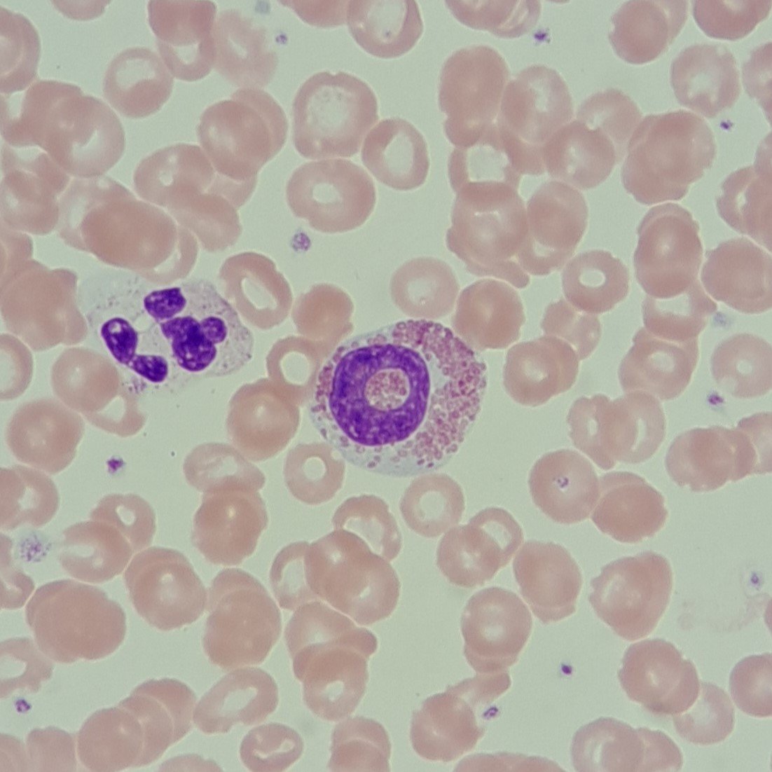 Eosinophils: Identification & Differentiation