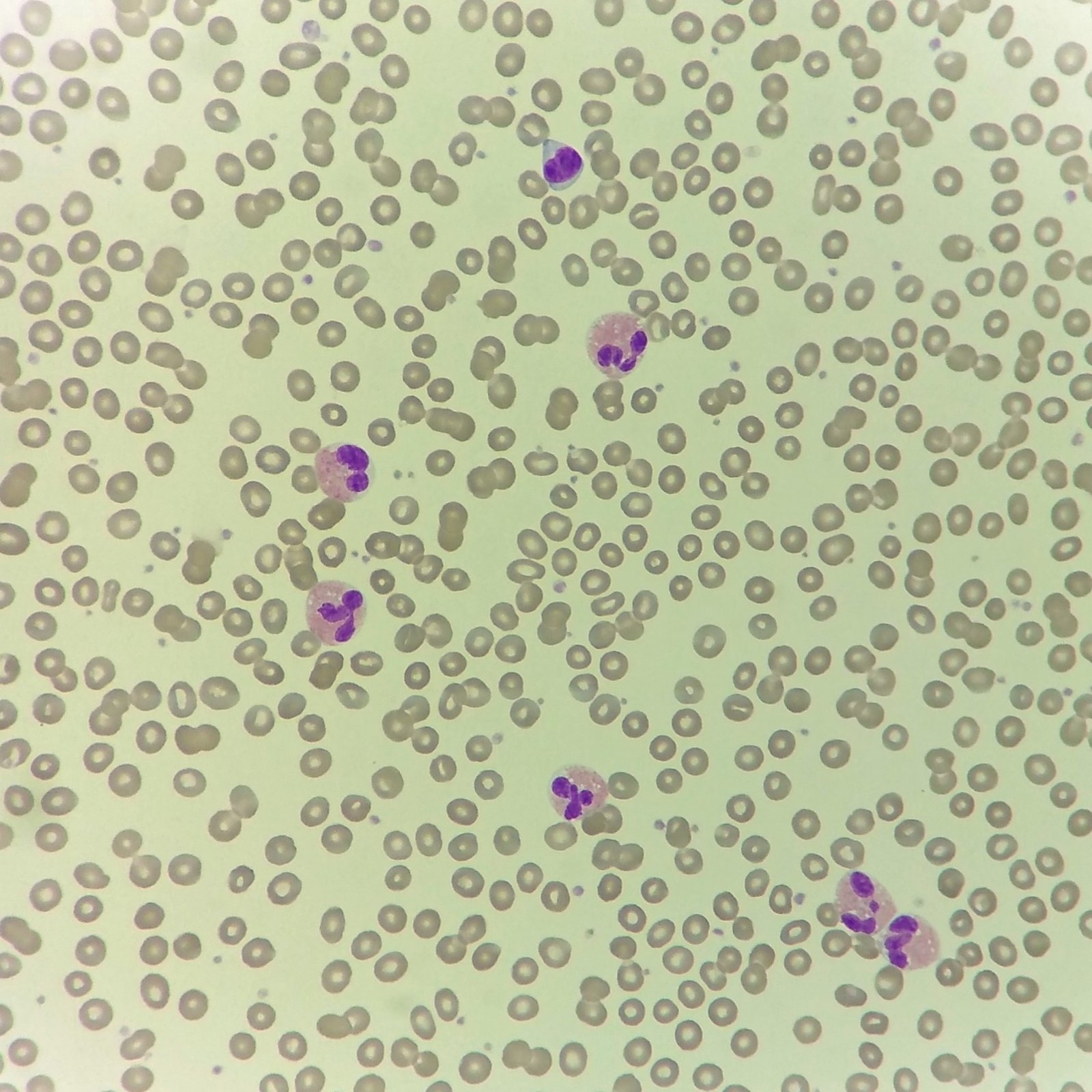 Eosinophils: Identification & Differentiation
