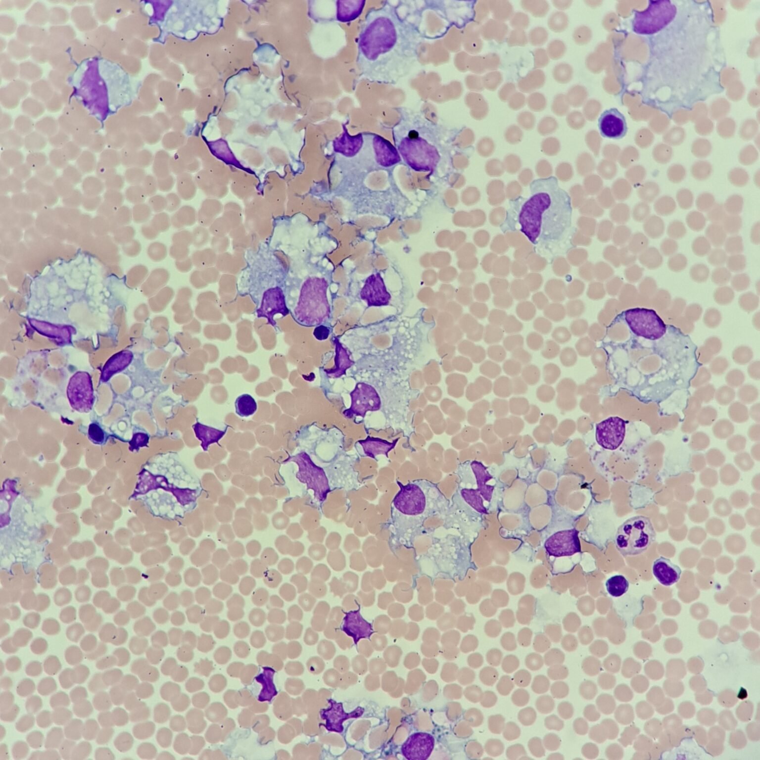 Body Fluid Monocytes / Macrophages - MedLabBuddy