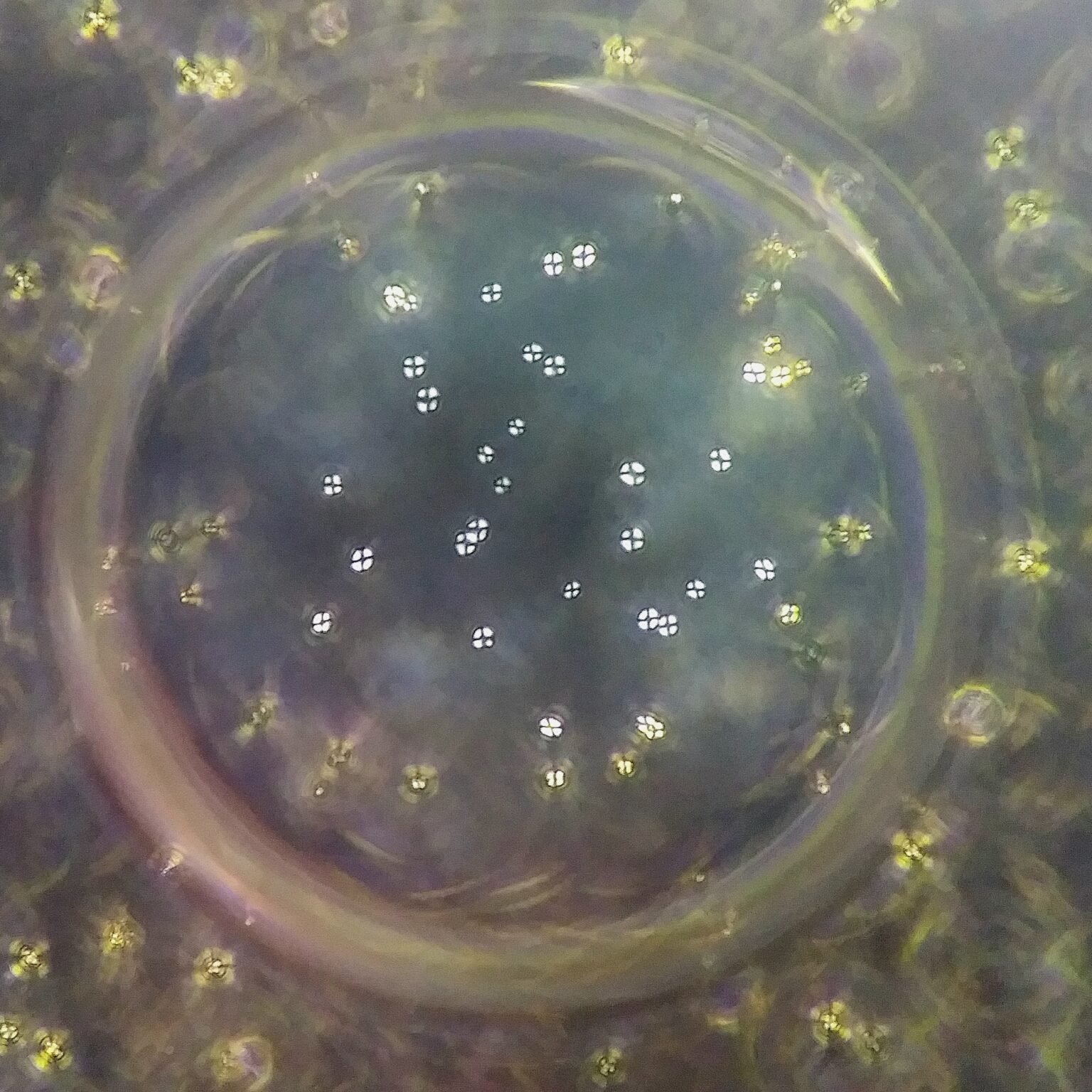 Fat Droplets in Urine - MedLabBuddy