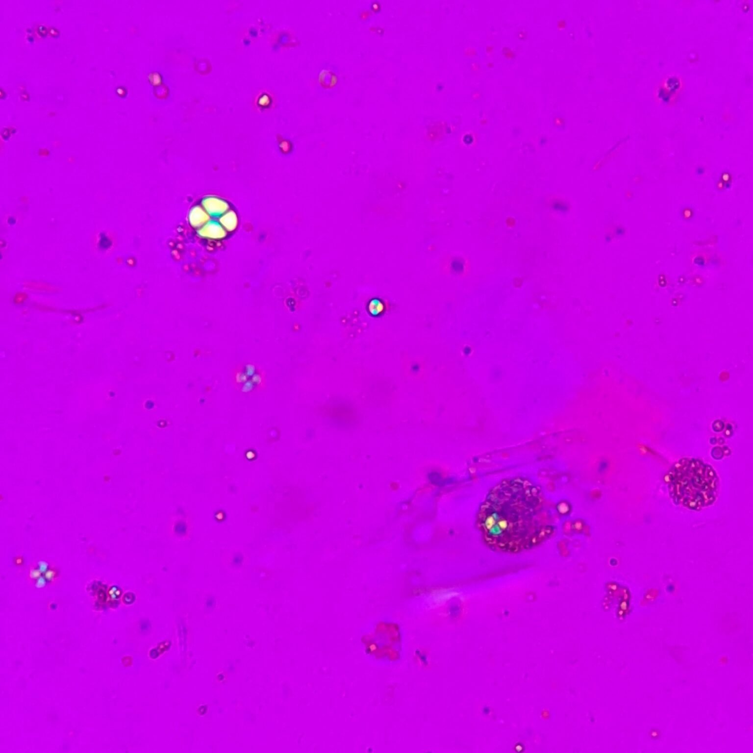 Fat Droplets in Urine - MedLabBuddy