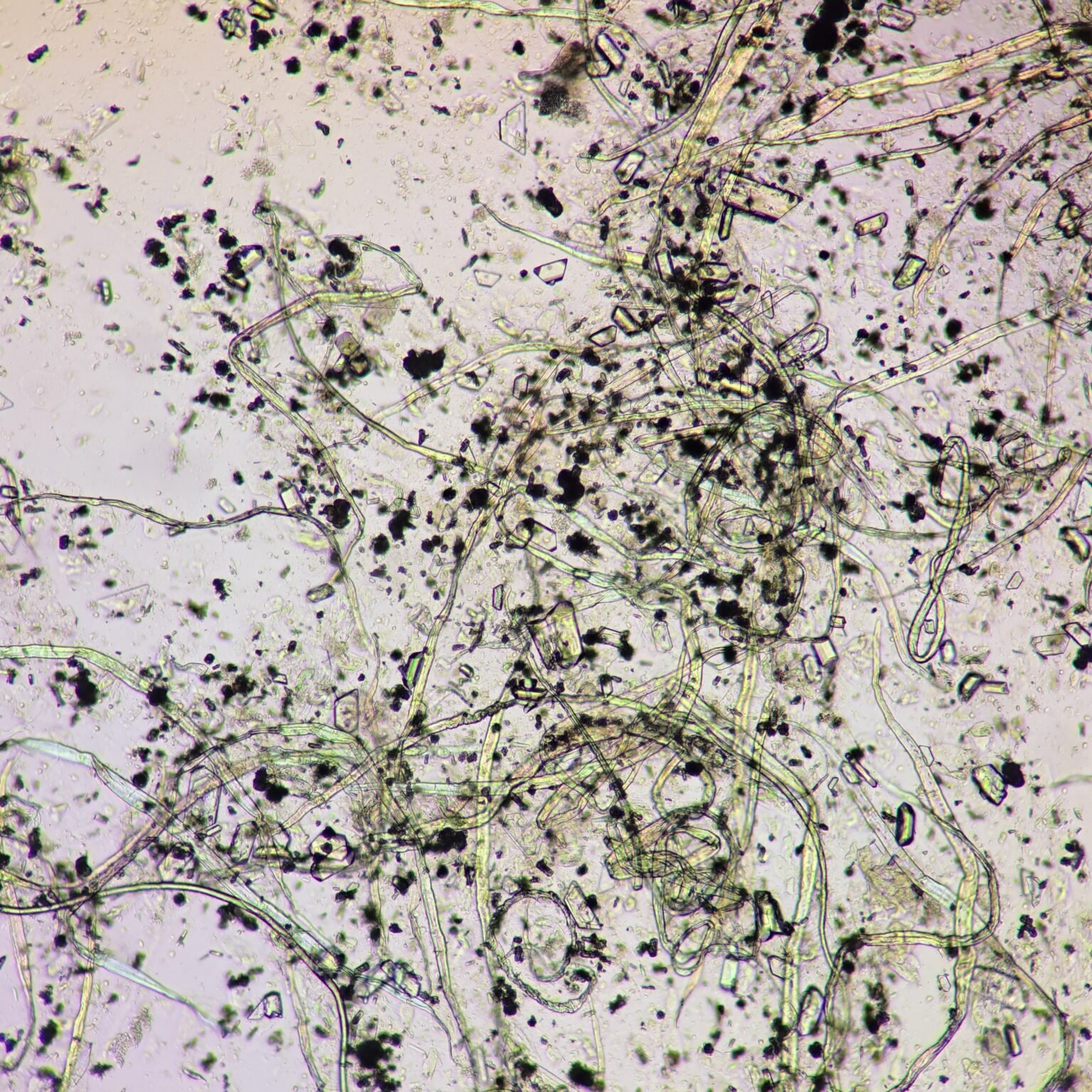 Waxy Casts: Identification & Significance - MedLabBuddy