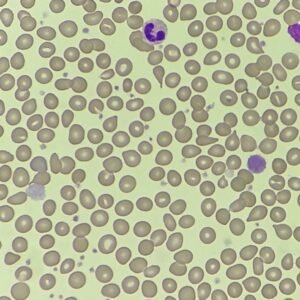 Platelets: Giant & Large, Clots & Clumps