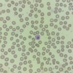 Platelets: Giant & Large, Clots & Clumps