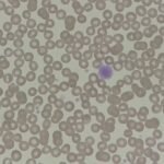 Platelets: Giant & Large, Clots & Clumps