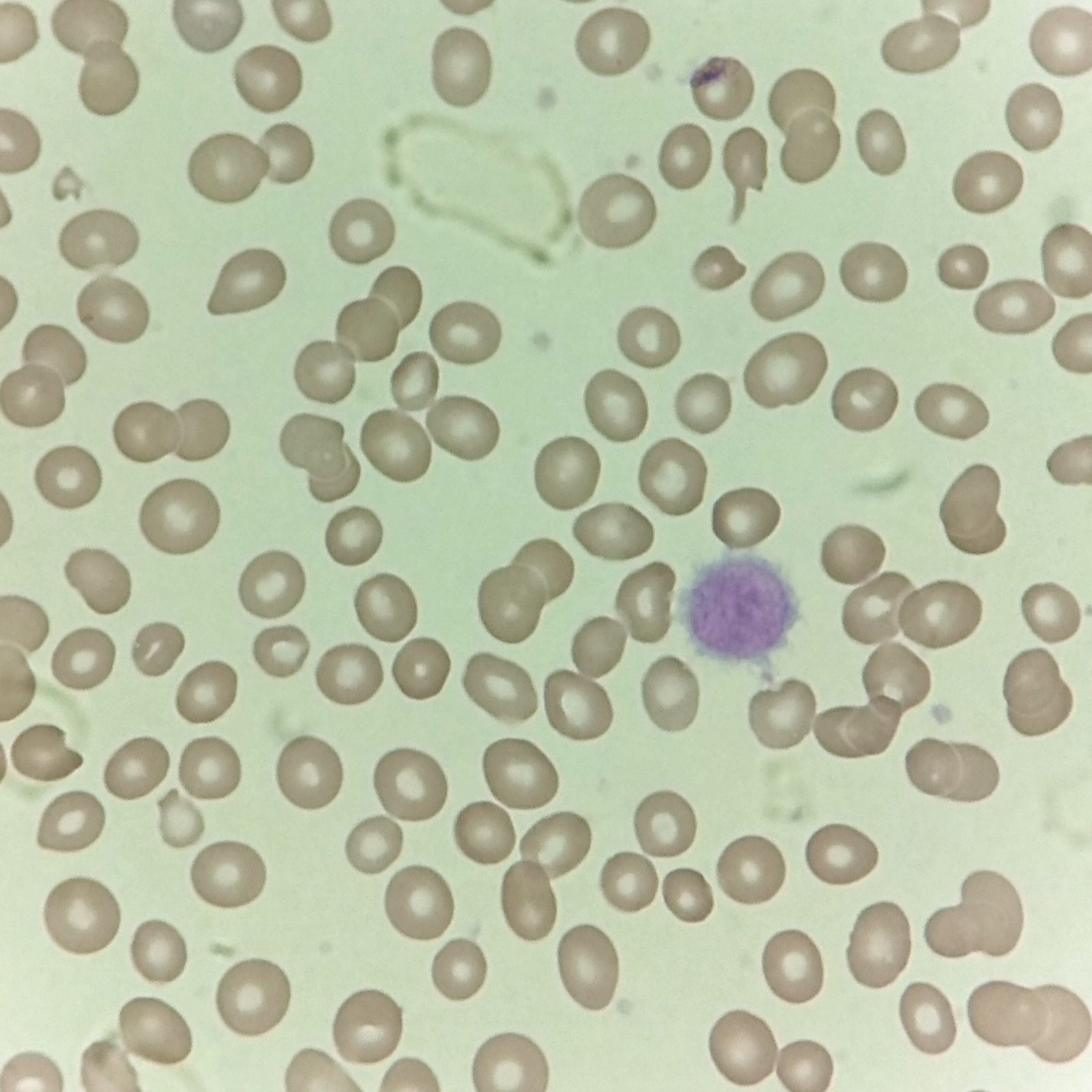 Platelets: Giant & Large, Clots & Clumps