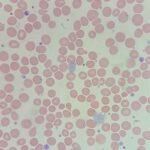 Platelets: Giant & Large, Clots & Clumps