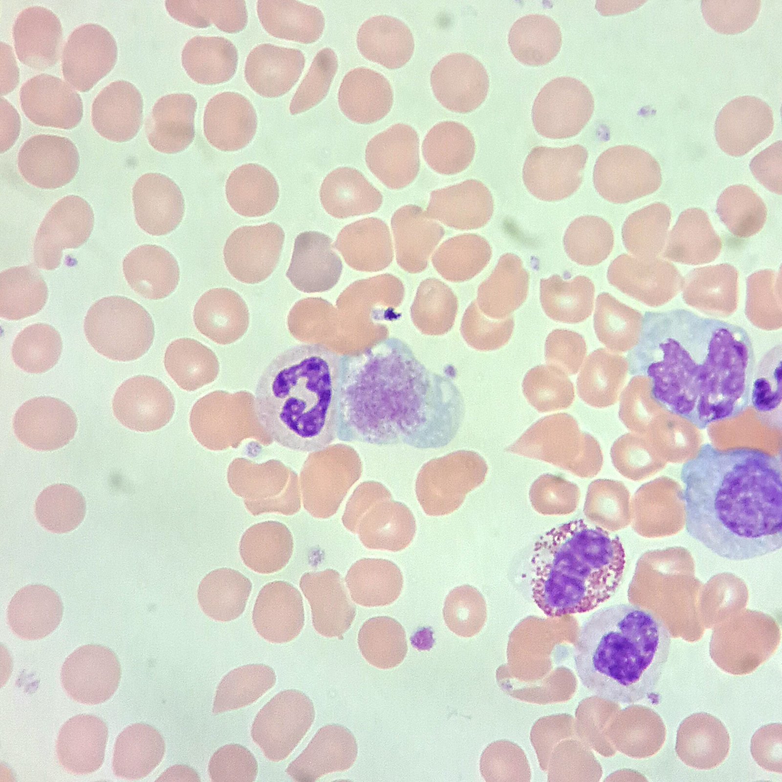 Platelets: Giant & Large, Clots & Clumps