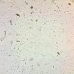 Granular Casts: Identification & Significance - MedLabBuddy