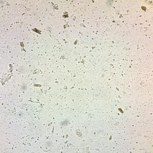 Urinary Casts: Identification & Significance