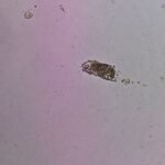 Urinary Casts: Identification & Significance