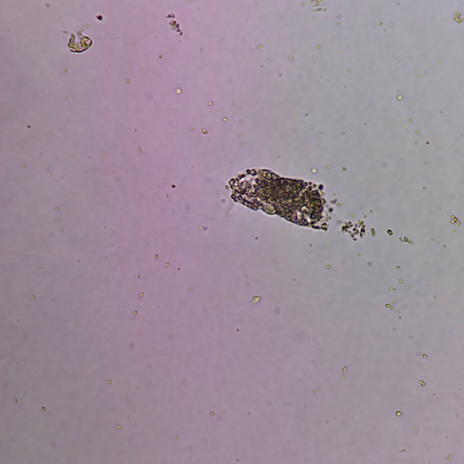 Granular Casts: Identification & Significance - MedLabBuddy