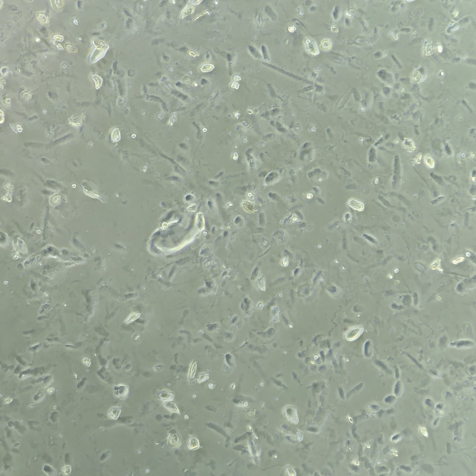 Hyaline Casts: Identification & Clinical Significance - MedLabBuddy