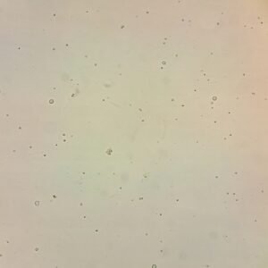 Urinary Casts: Identification & Significance