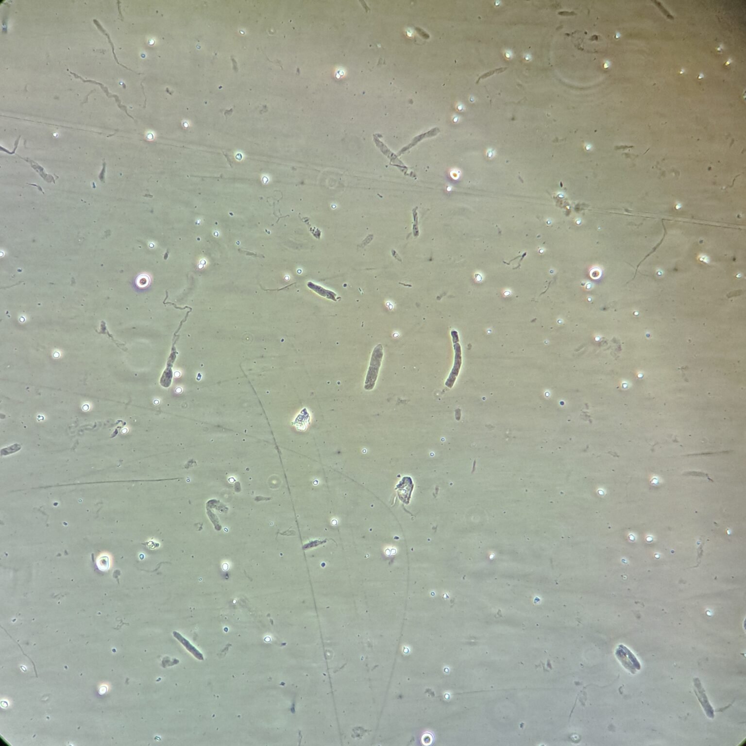 Hyaline Casts: Identification & Clinical Significance - MedLabBuddy