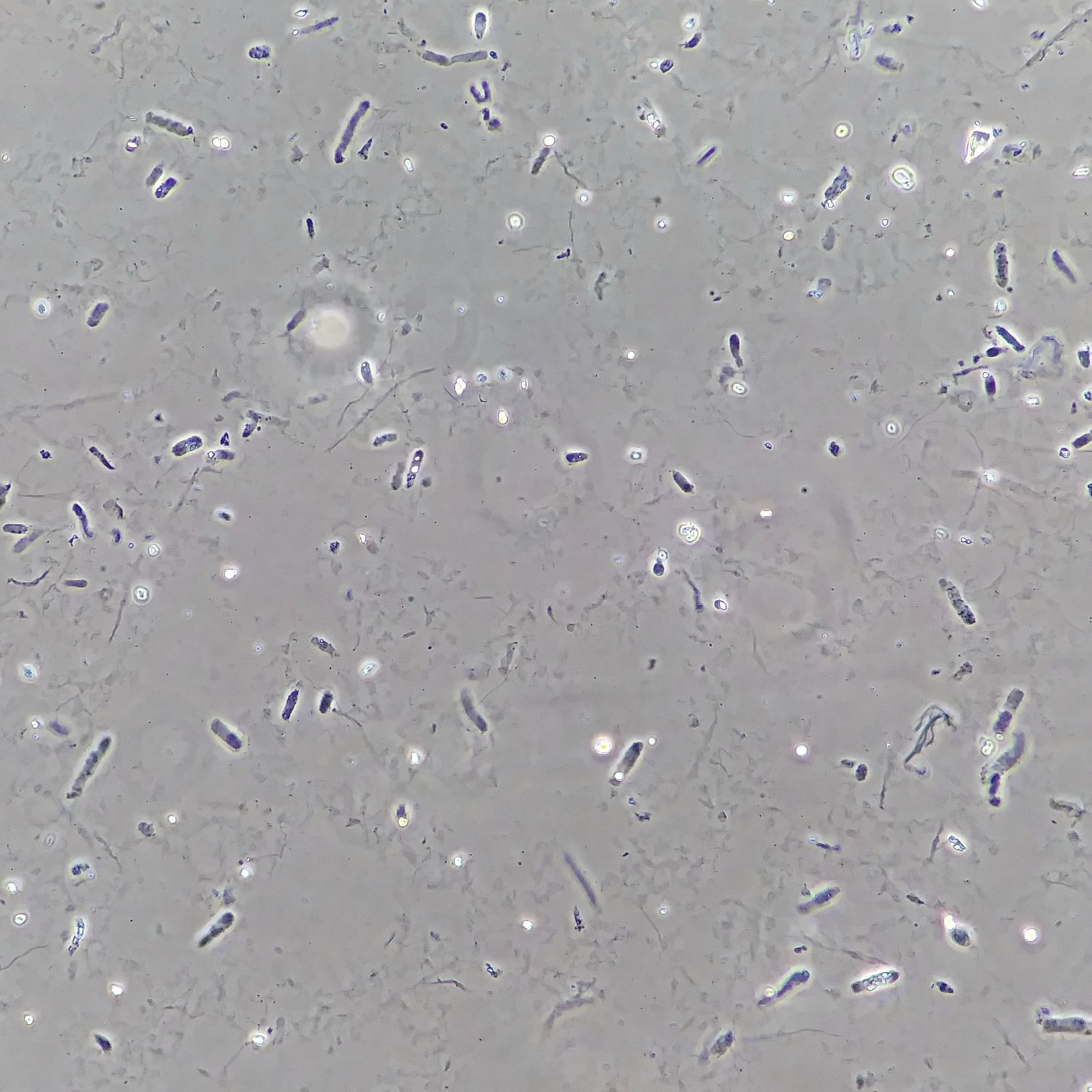 Urinary Casts: Identification & Significance