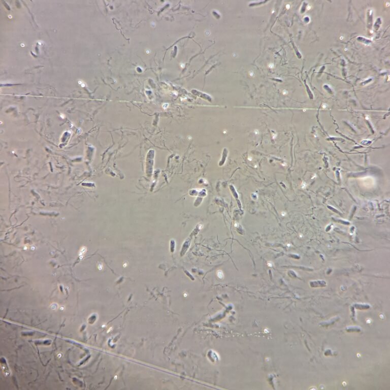 Waxy Casts: Identification & Significance - MedLabBuddy