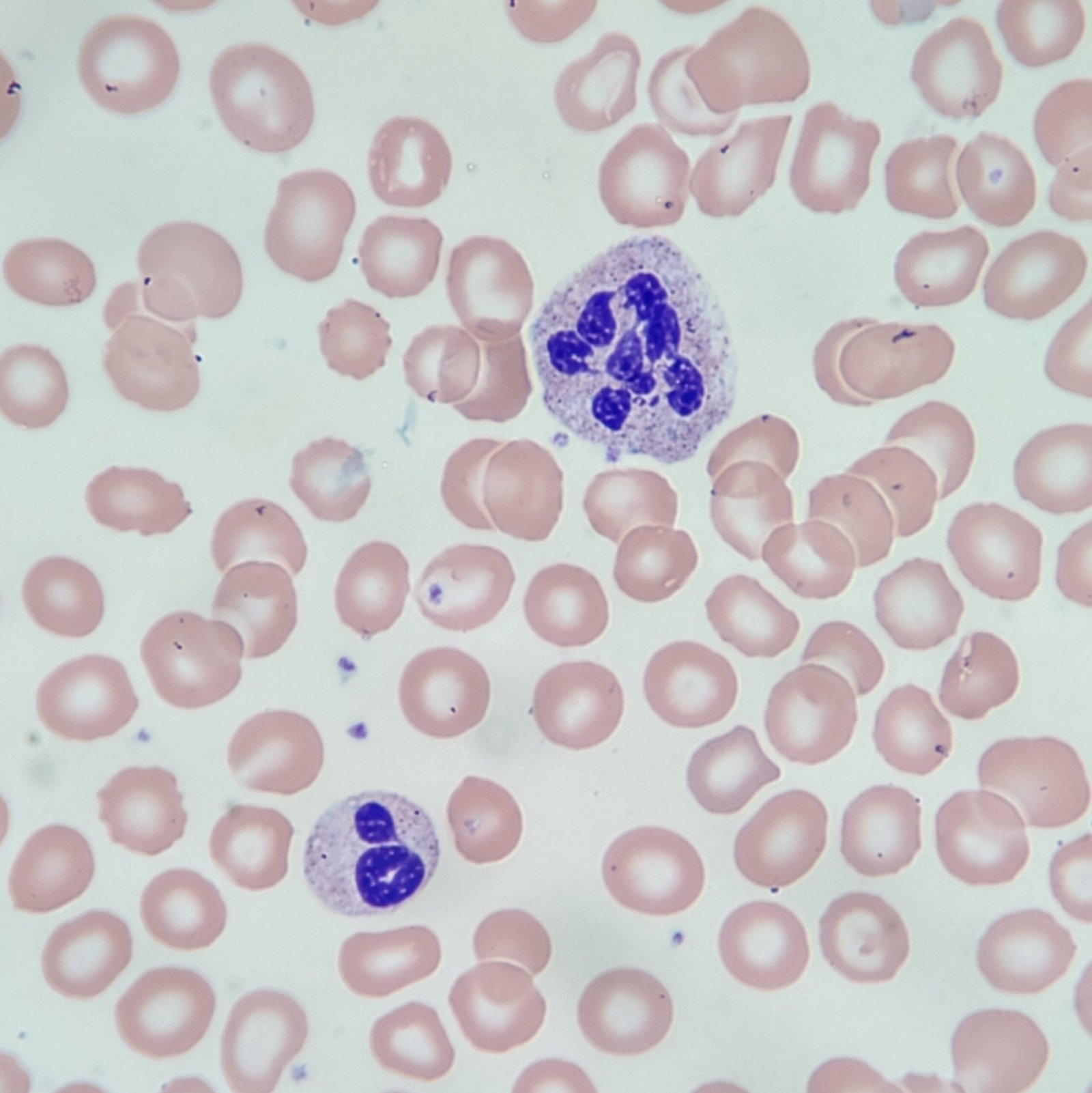Hypersegmentation: Appearance & Clinical Significance - MedLabBuddy