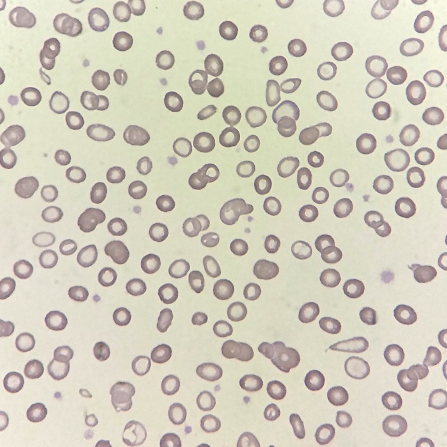 RBC Morphology Based on Indices