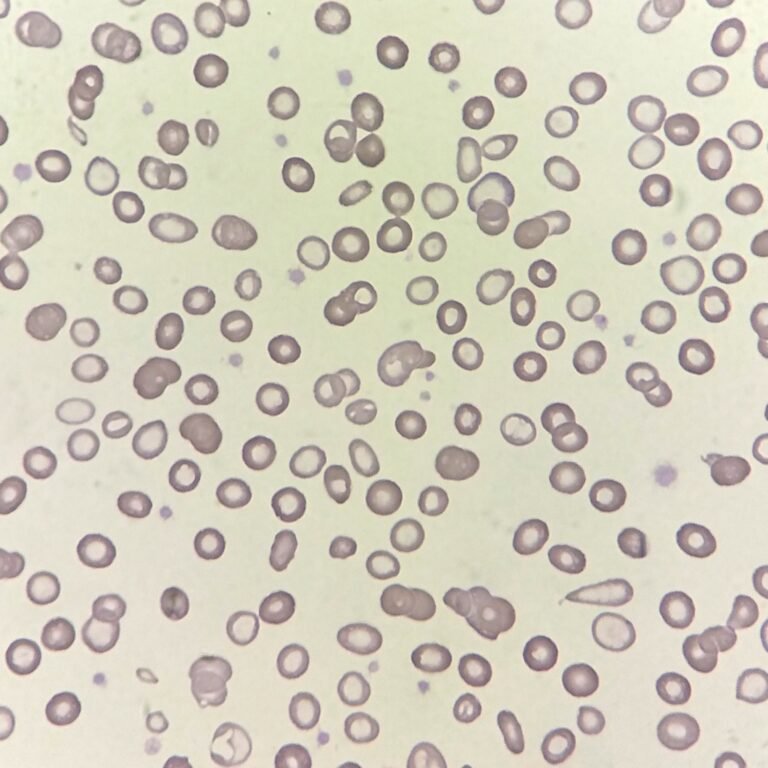 RBC Morphology Based on Indices