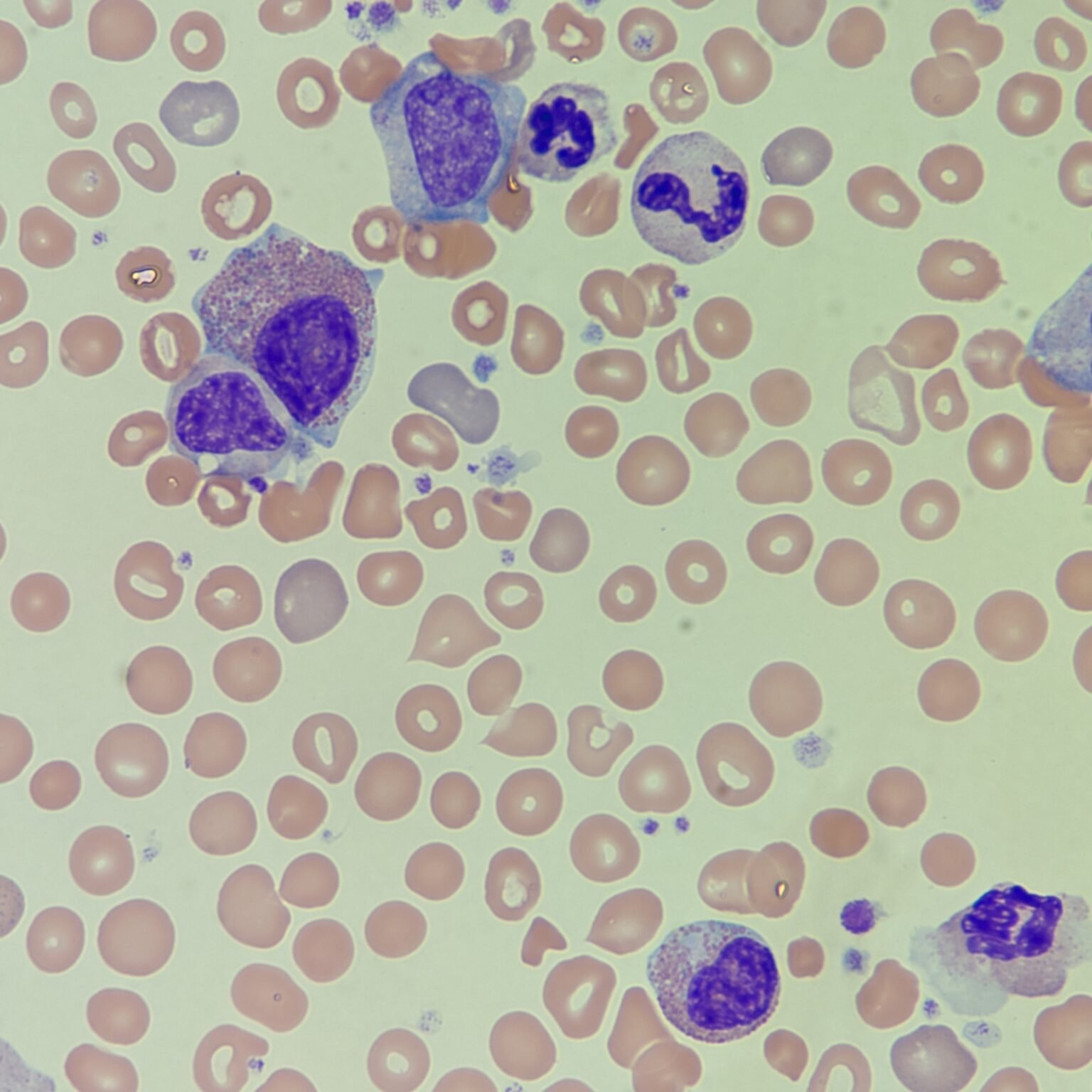 Eosinophils: Identification & Differentiation
